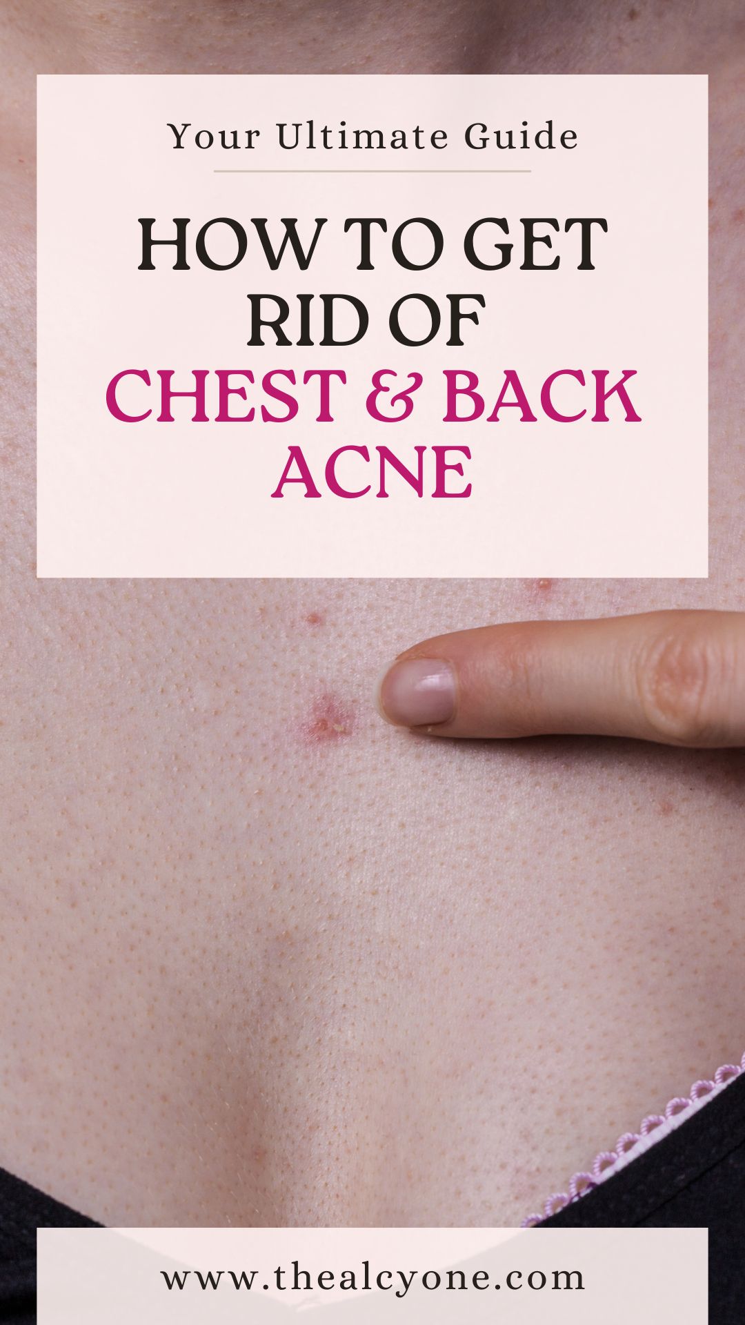 How To Get Rid Of Chest Acne And Bacne - The Alcyone