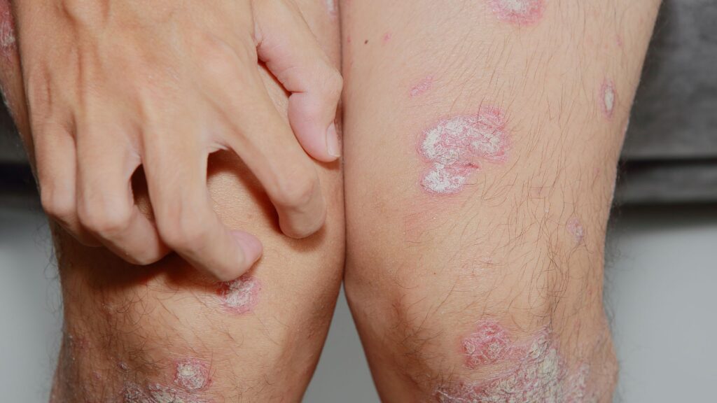 Psoriasis Causes, Triggers And Skincare Routine - The Alcyone