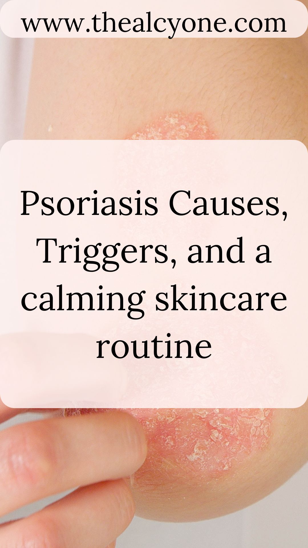 Psoriasis Causes, Triggers And Skincare Routine - The Alcyone