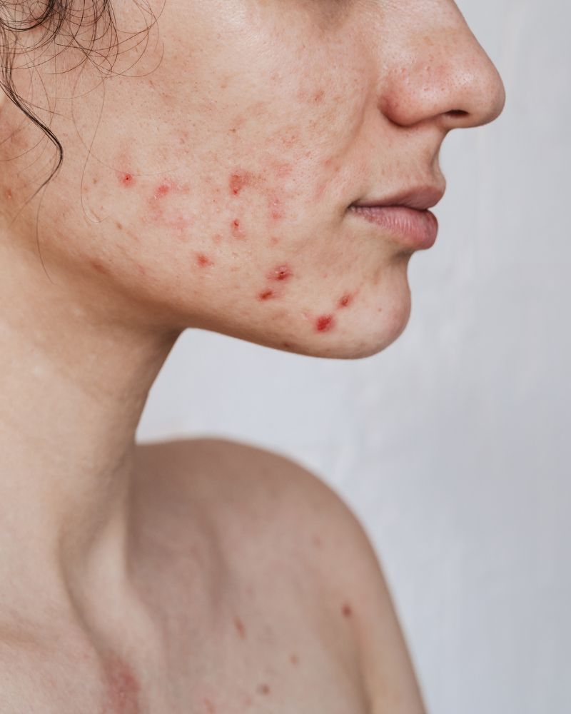 How To Treat Hormonal Acne Naturally & Skincare Products